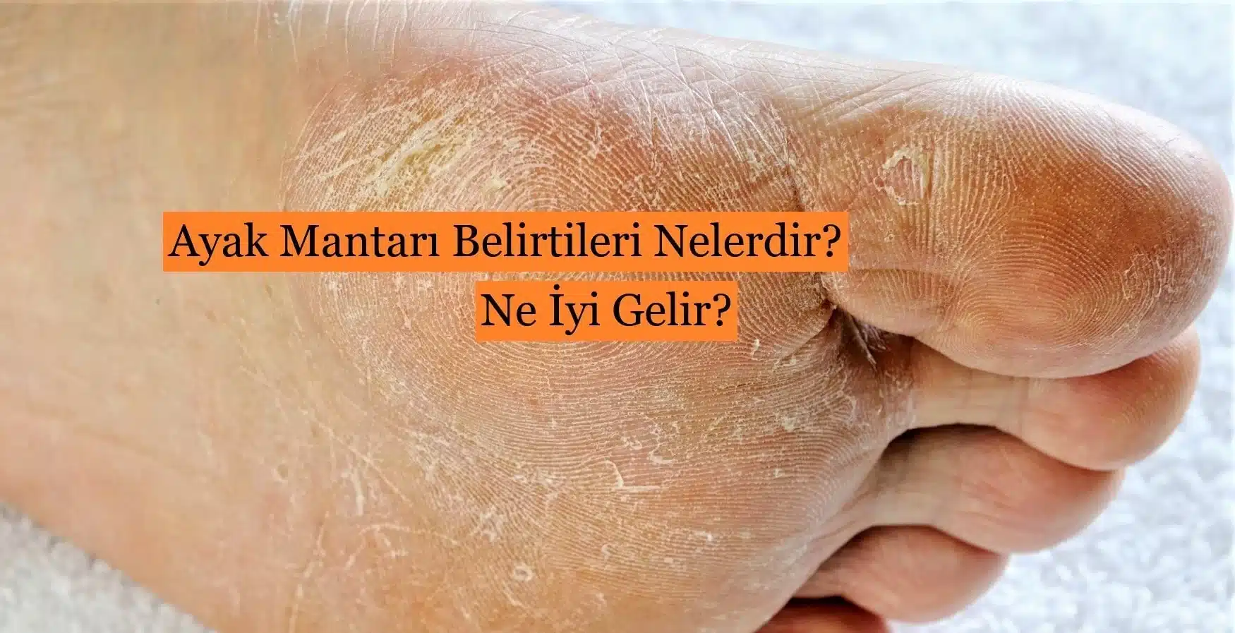 Ayak Mantarı Nedir? Belirtileri Nelerdir? Ayak Bakimi - Dantel ...